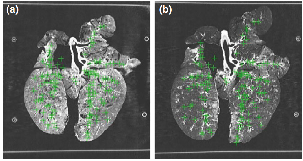Surgery Navigation Can Also Be Used for Lung----Chinese Academy of Sciences
